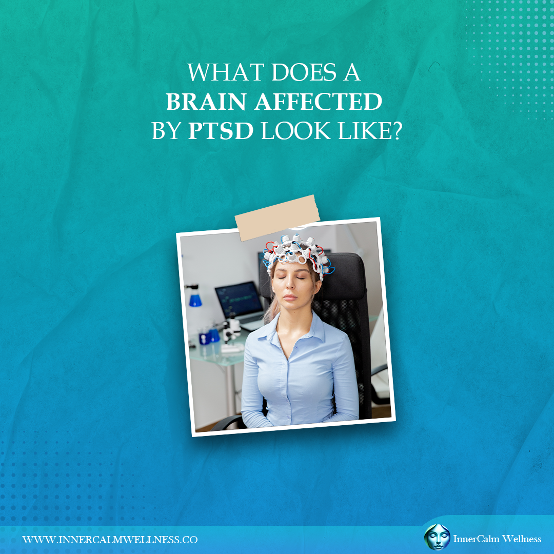 What Does a Brain Affected by PTSD Look Like